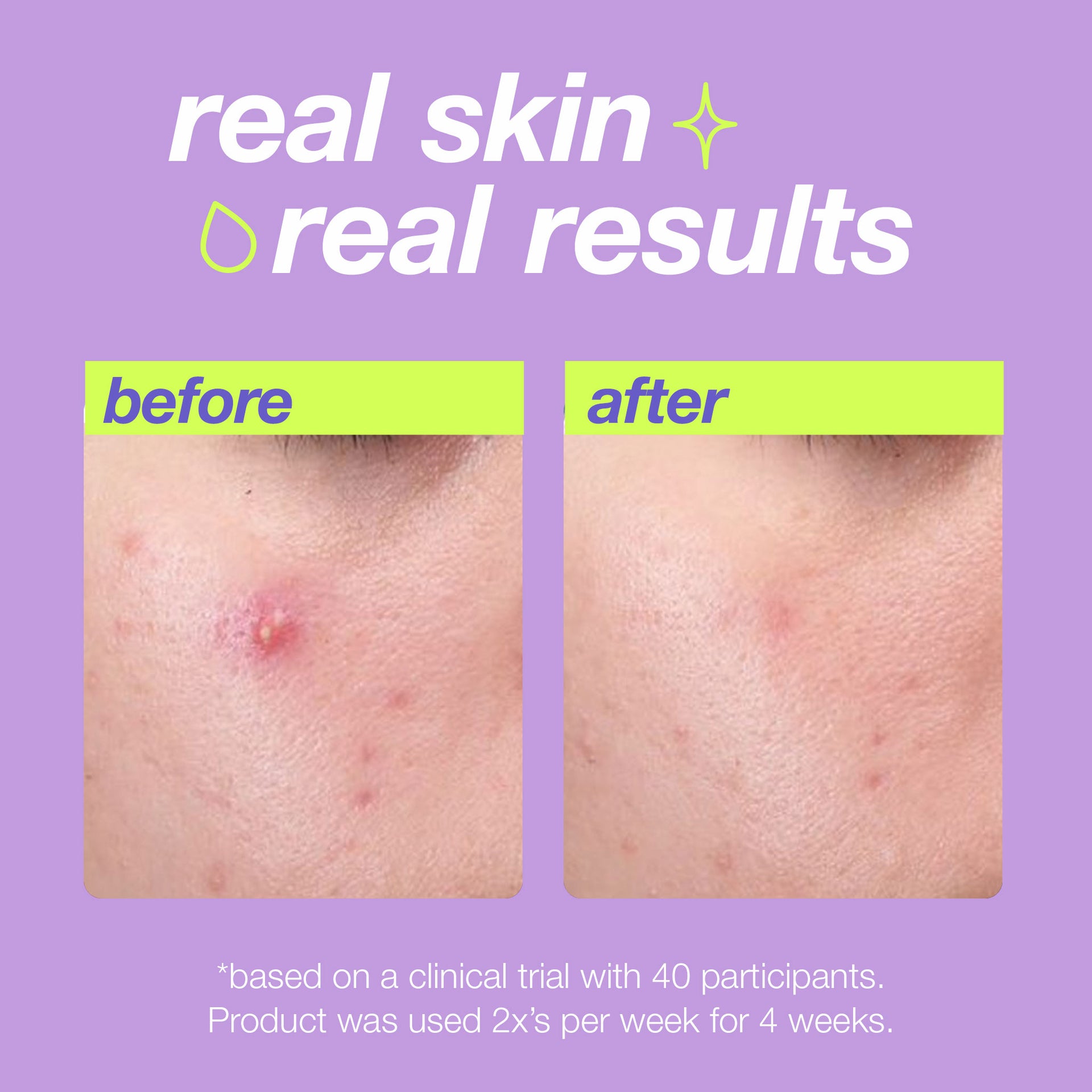 Breakout Clearing Liquid Peel – Dermalogica IE